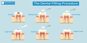 Everything You Need to Know About Dental Fillings: Types, Procedures, and Benefits