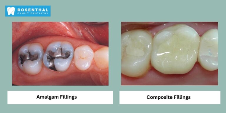 Types of Dental Fillings: Which One Is Best for You?